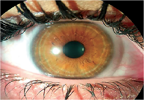 Contact Lens Spectrum | PentaVision