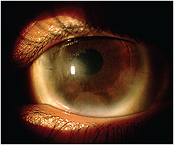 Contact Lens Spectrum | PentaVision
