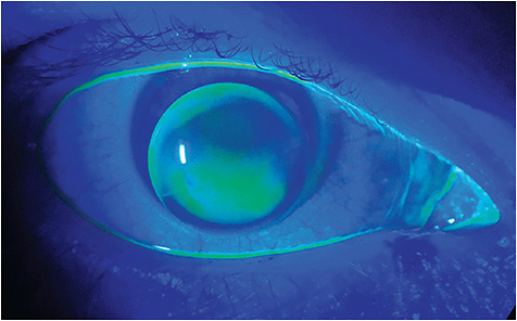 Contact Lens Spectrum | PentaVision