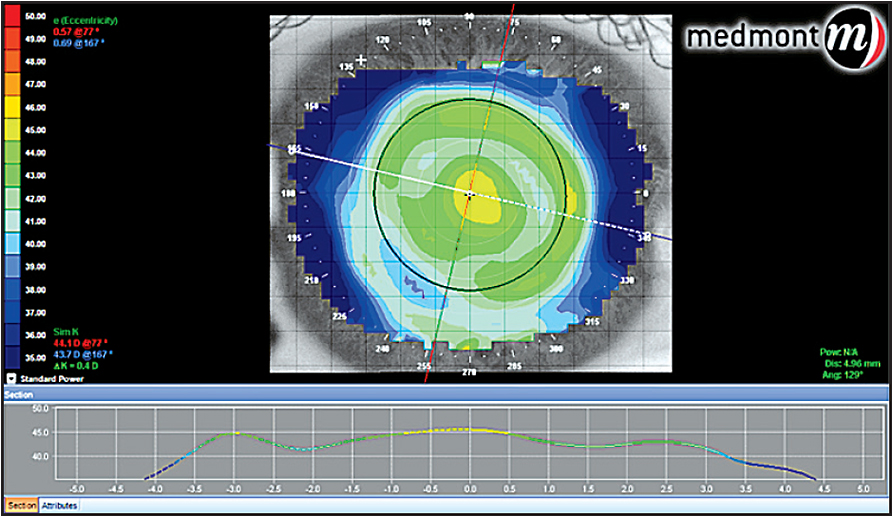 Contact Lens Spectrum | PentaVision
