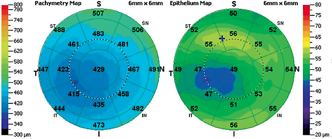 Contact Lens Spectrum | PentaVision