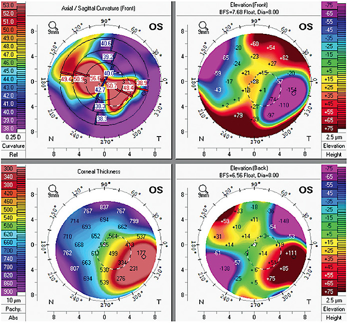 Contact Lens Spectrum | PentaVision