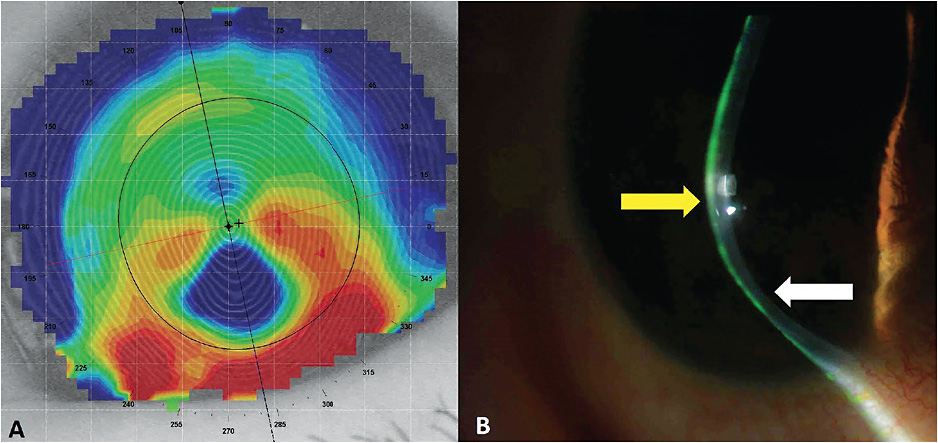 Contact Lens Spectrum | PentaVision