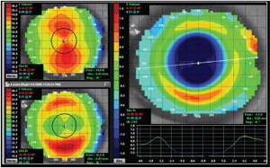 Contact Lens Spectrum | PentaVision