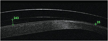 Contact Lens Spectrum | PentaVision
