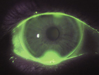 Contact Lens Spectrum | PentaVision