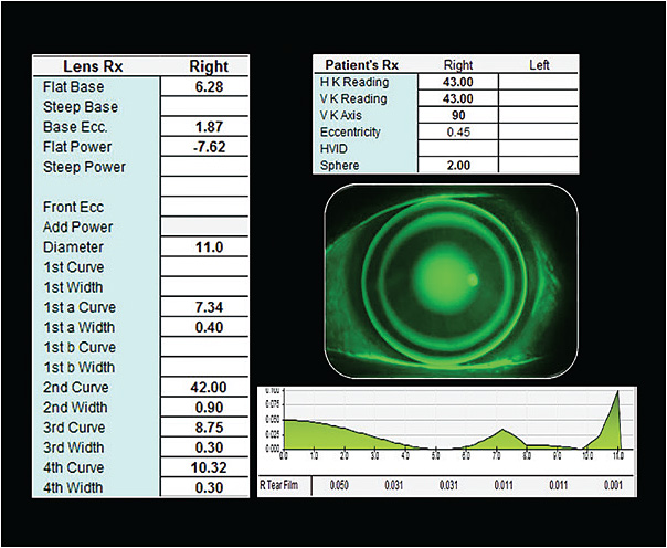 Contact Lens Spectrum | PentaVision