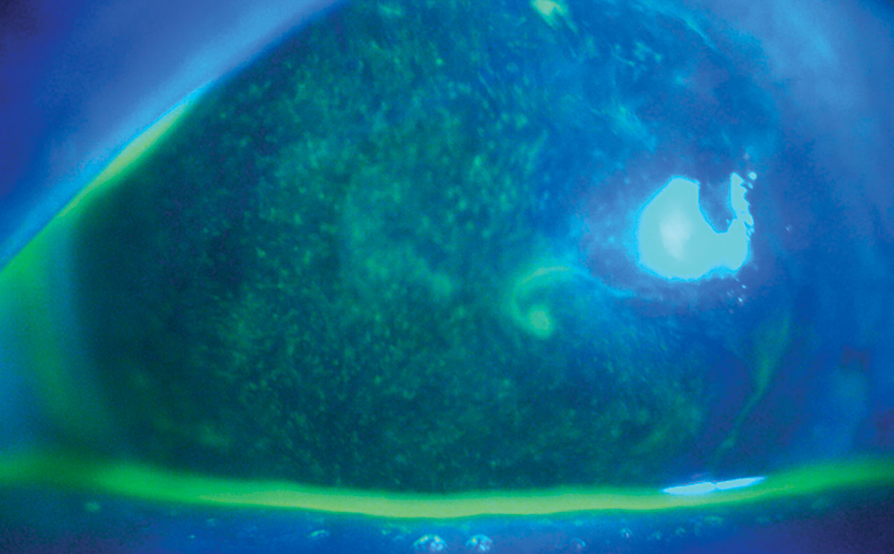 DRY EYE DX AND TX | Contact Lens Spectrum