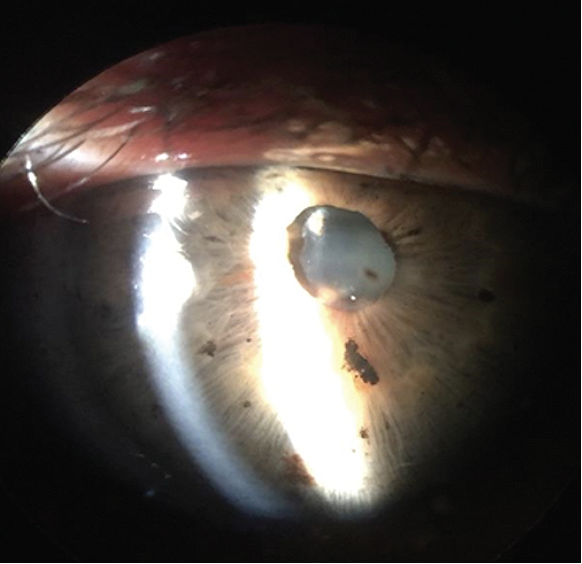 Specialty Fit to Improve Vision After Foreign Body | Contact Lens Spectrum