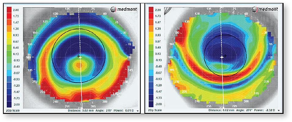 Contact Lens Spectrum | PentaVision