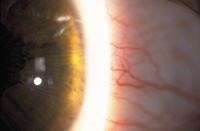 Contact Lens Spectrum | PentaVision