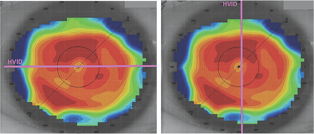 Contact Lens Spectrum | PentaVision