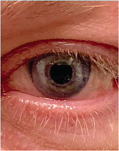 Contact Lens Spectrum | PentaVision