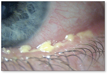 Contact Lens Spectrum | PentaVision