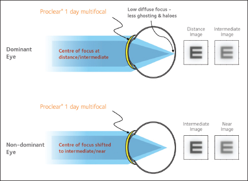 Contact Lens Spectrum | PentaVision