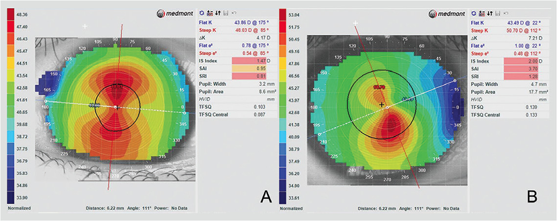 Contact Lens Spectrum | PentaVision