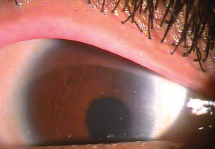 Contact Lens Spectrum | PentaVision