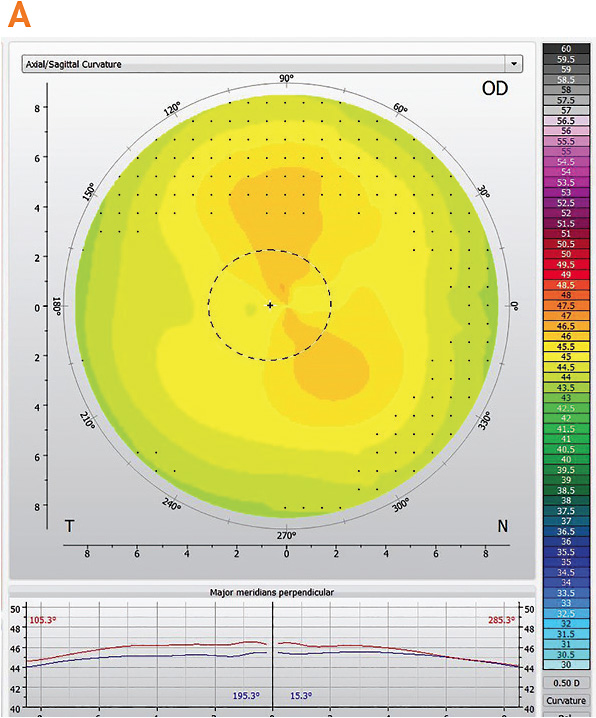 Contact Lens Spectrum | PentaVision