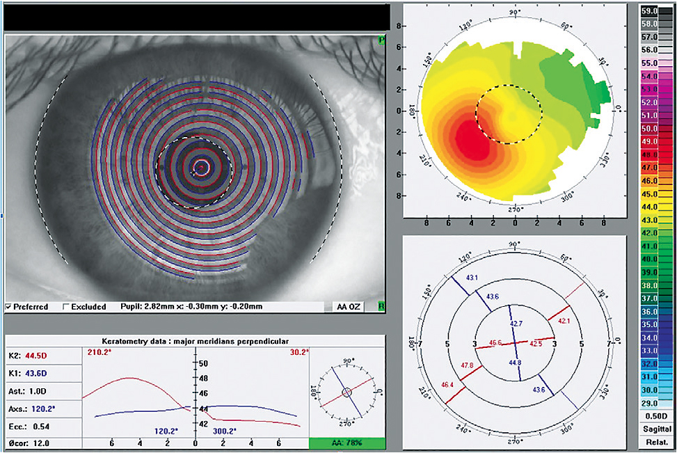 Contact Lens Spectrum | PentaVision