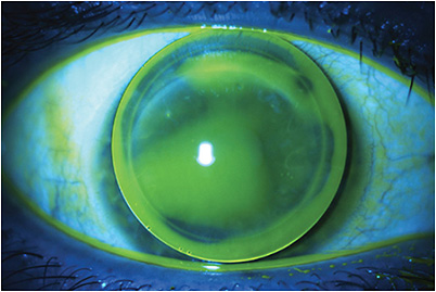 Contact Lens Spectrum | PentaVision