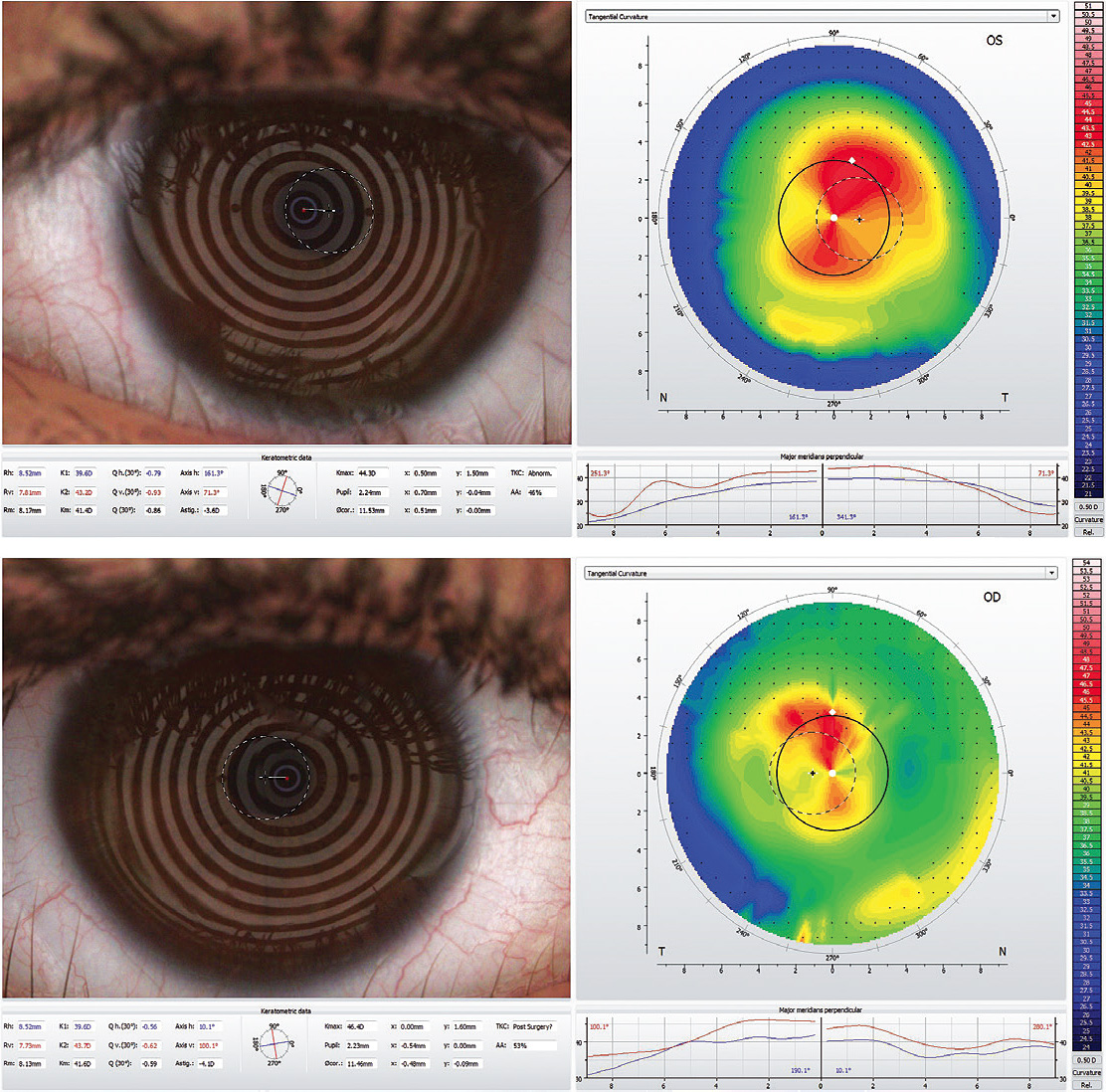 Contact Lens Spectrum | PentaVision