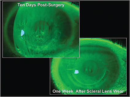 Contact Lens Spectrum | PentaVision