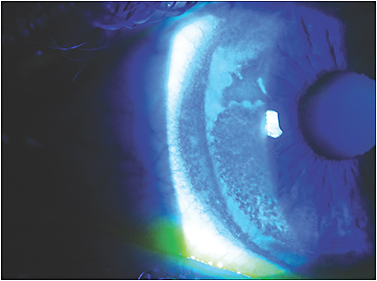 Contact Lens Spectrum | PentaVision