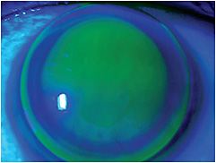 Contact Lens Spectrum | PentaVision