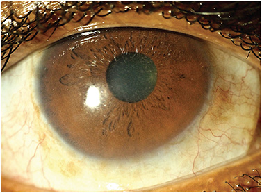 Contact Lens Spectrum | PentaVision