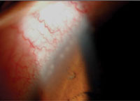 Contact Lens Spectrum | PentaVision