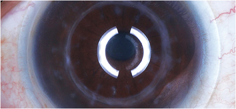 Contact Lens Spectrum | PentaVision