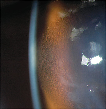 Contact Lens Spectrum | PentaVision