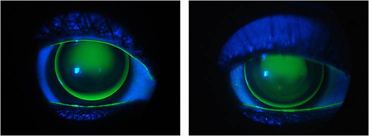 Contact Lens Spectrum | PentaVision