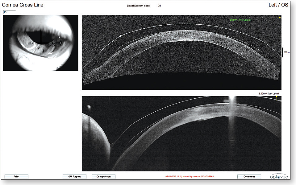 Contact Lens Spectrum | PentaVision