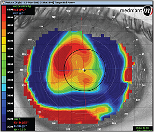 Contact Lens Spectrum | PentaVision