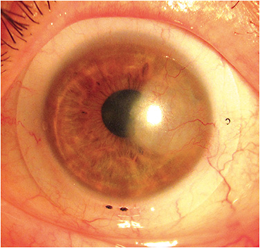 Contact Lens Spectrum | PentaVision