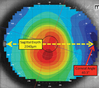 Contact Lens Spectrum | PentaVision