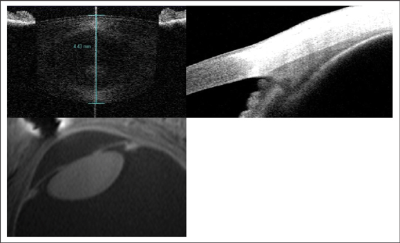Contact Lens Spectrum | PentaVision