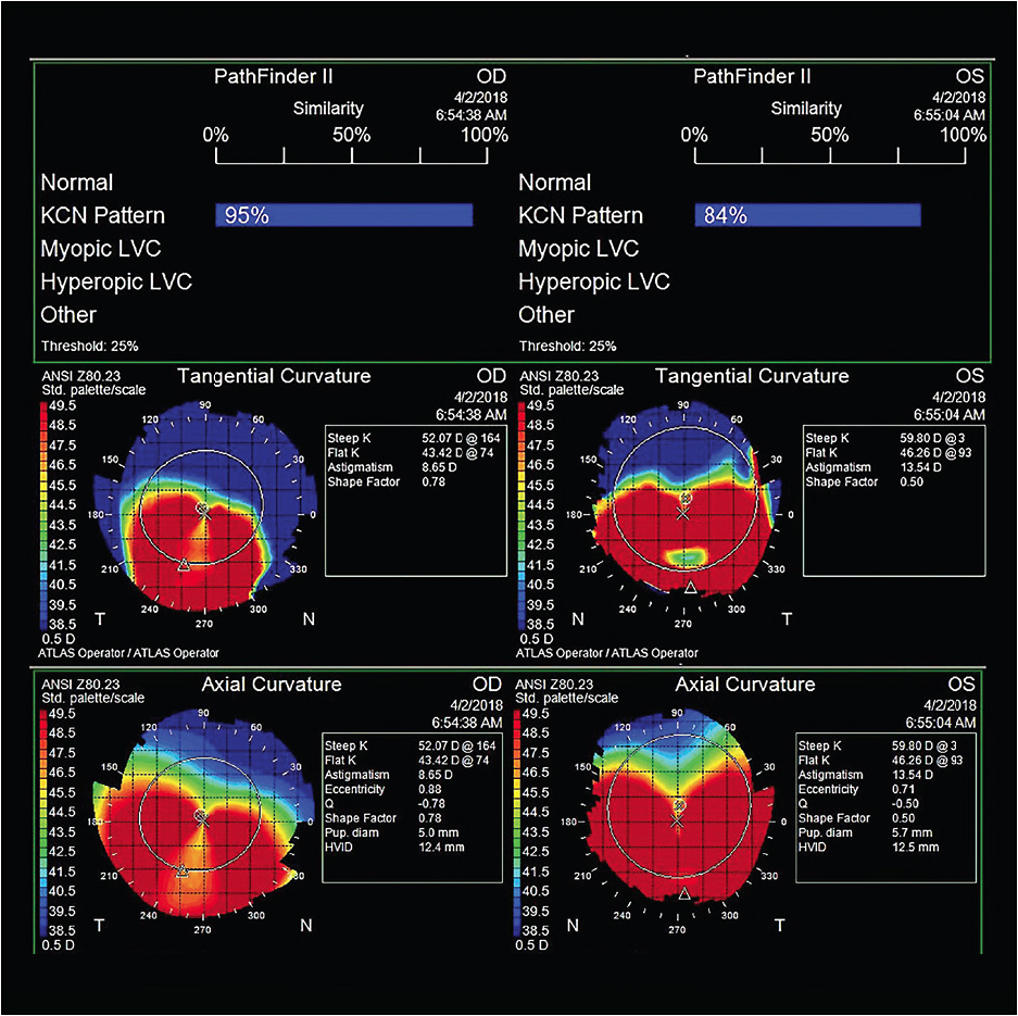 Contact Lens Spectrum | PentaVision