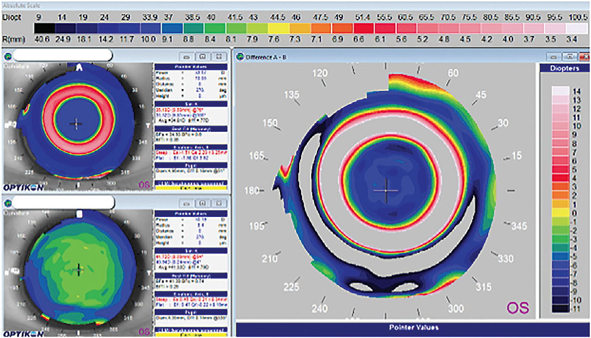 Contact Lens Spectrum | PentaVision