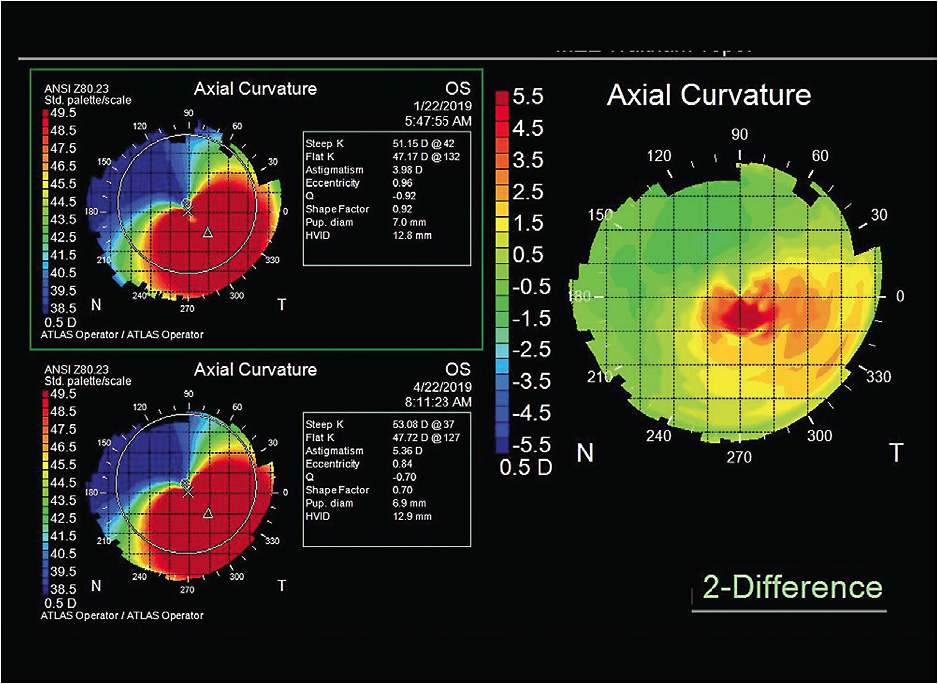 Contact Lens Spectrum | PentaVision
