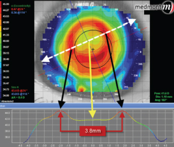 Contact Lens Spectrum | PentaVision