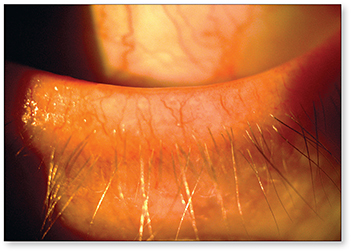 Contact Lens Spectrum | PentaVision
