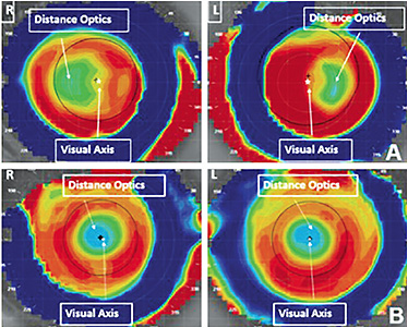 Contact Lens Spectrum | PentaVision