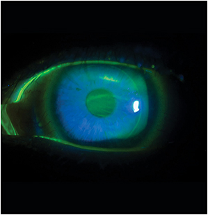 Contact Lens Spectrum | PentaVision