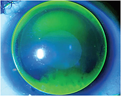 Contact Lens Spectrum | PentaVision