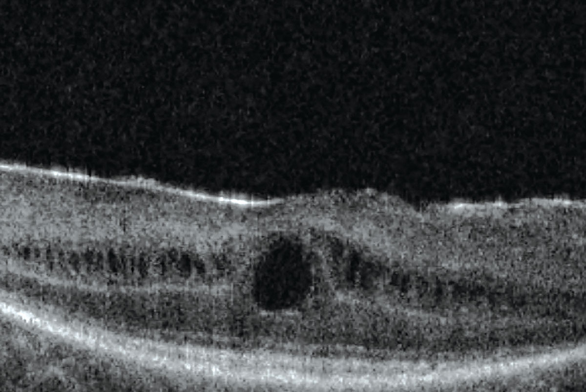 THE SCLERAL LENS VAULT | Contact Lens Spectrum