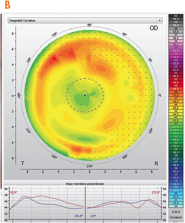 Contact Lens Spectrum | PentaVision