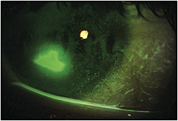 DRY EYE DX AND TX | Contact Lens Spectrum