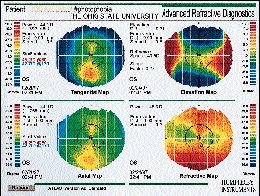 Contact Lens Spectrum | PentaVision